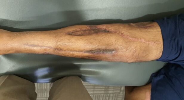SAVING A LIMB FROM AMPUTATION AFTER COMPLEX KNEE TRAUMA | Dr Sathappan