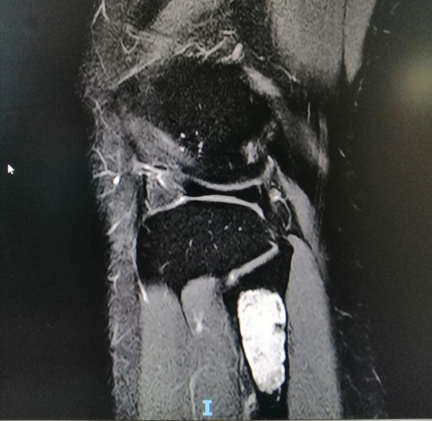 PAINFUL CYSTIC SWELLINGS AROUND THE KNEE | Dr Sathappan